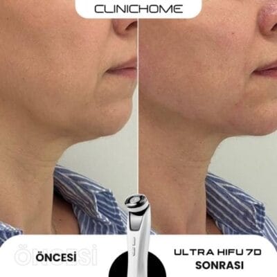 Ultra Hifu 7D - Clinichome