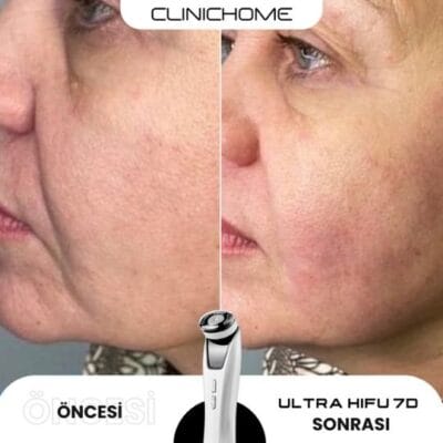 Ultra Hifu 7D - Clinichome