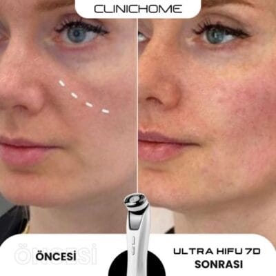 Ultra Hifu 7D - Clinichome